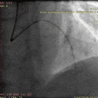 Safety Gained 充分预处理专题 | OCT指导下应用NSE棘突球囊治疗ISR一例-搜狐大视野-搜狐新闻