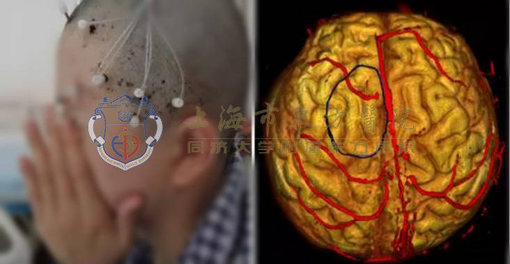 SEEG微创手术技术 让频繁癫痫消失不见_患者