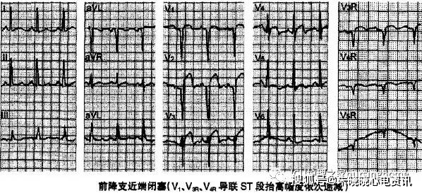 心肌梗死的心电图定位诊断_avR