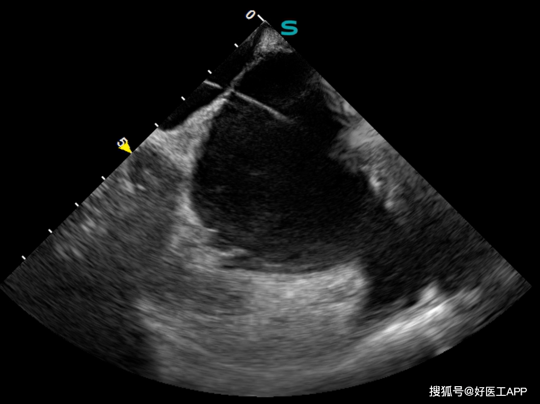 中国首个国产ICE系统注册临床，全国首例入组_超声_技术_左心