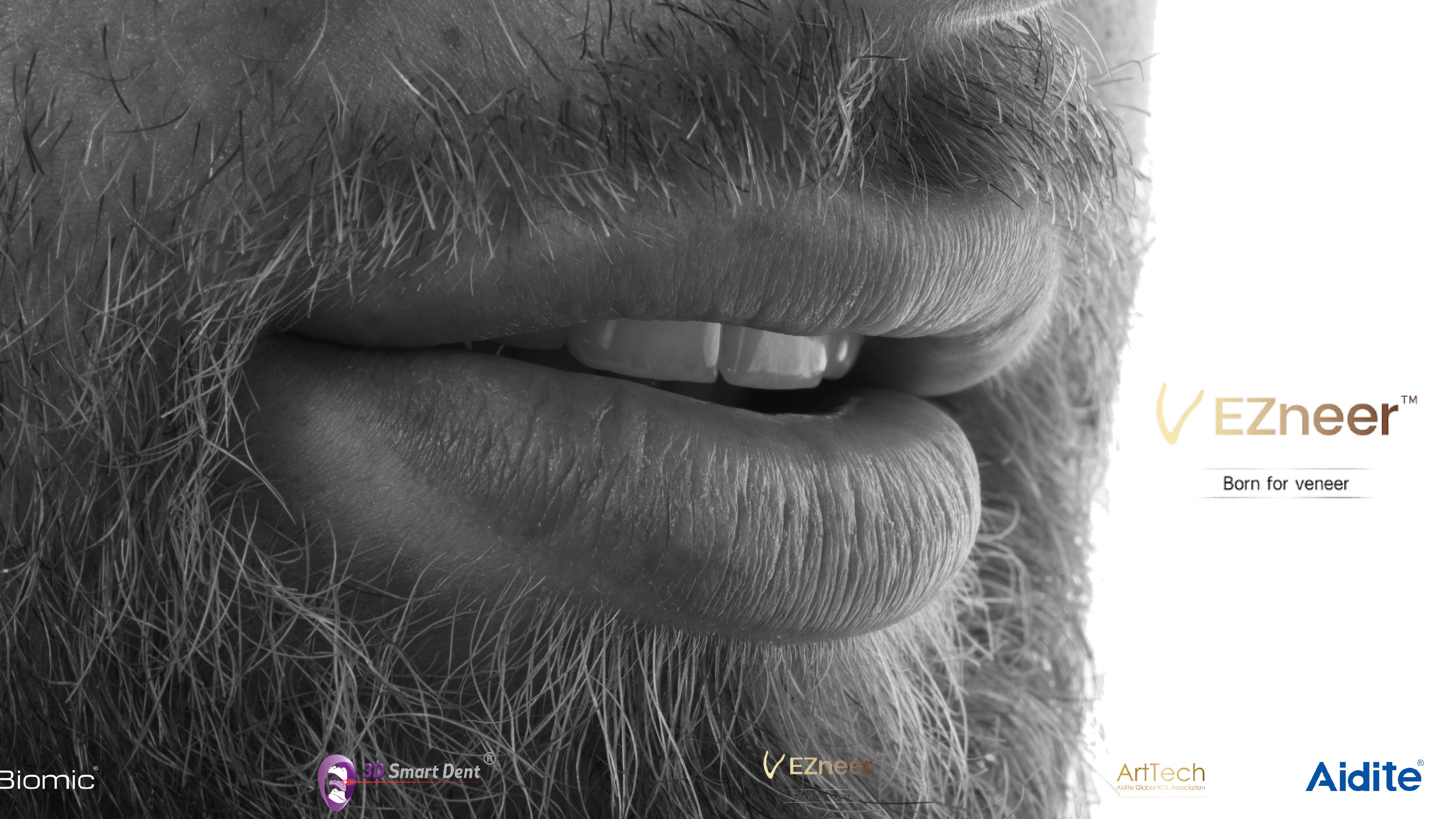 爱迪特 #EZneer病例赏析# Born for veneer!-搜狐大视野-搜狐新闻