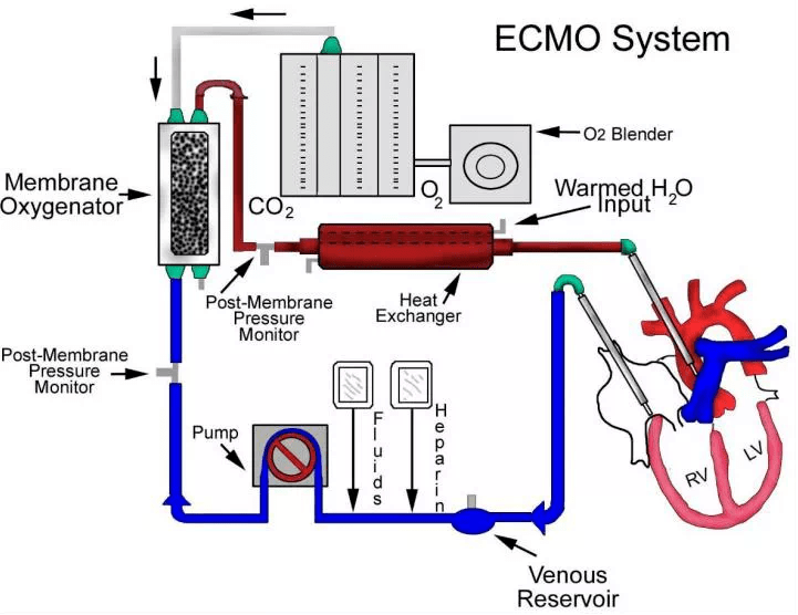 【干货】突破国外ECMO技术壁垒？深究全球技术布局是首要！（文末附报告）_氧合器