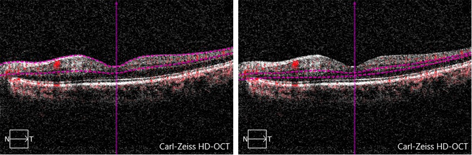每周最佳病例分享 | 又见PAMM 疏影横斜水清浅，隐忧浮动月黄昏_acute