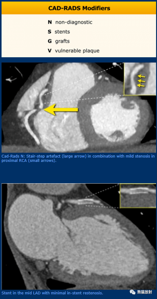 CAD-RADS 冠状动脉疾病报告和数据系统_诊断
