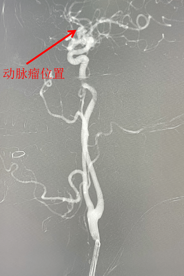 送无阻、顺必达—Phenom™ 27微导管在前循环远端血管中的应用_支架_Flex_血流