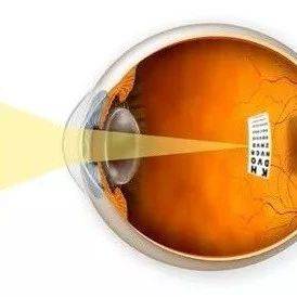 近视虽然无法治愈，但可防可控_检查_影响因素_视力