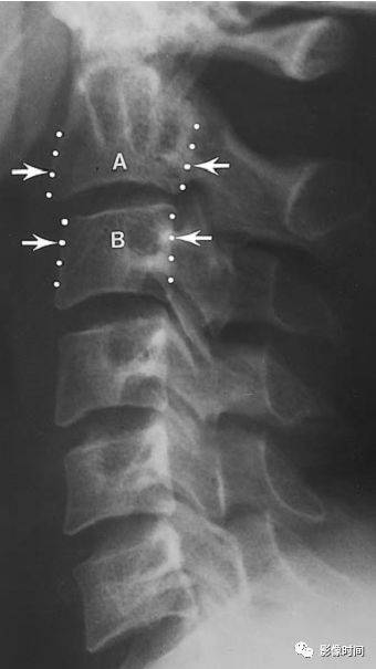 三十个脊柱影像征象，您都见过么_关节_sign_颈椎
