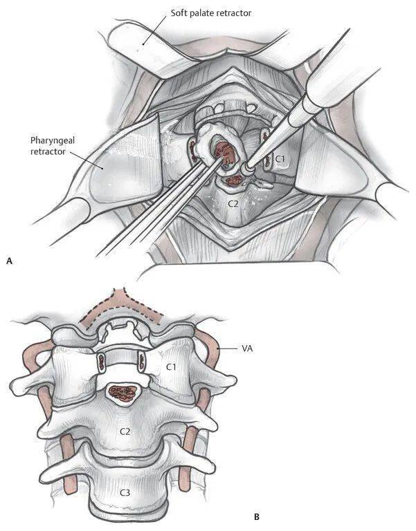 Thieme｜经口咽入路到达颅颈交界区图解_the_soft_palate