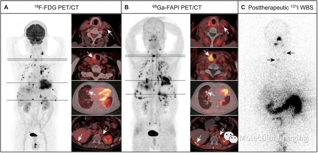 【学术】陈皓鋆教授团队 | 68Ga-FAPI PET/CT头对头研究_患者_治疗_阴性
