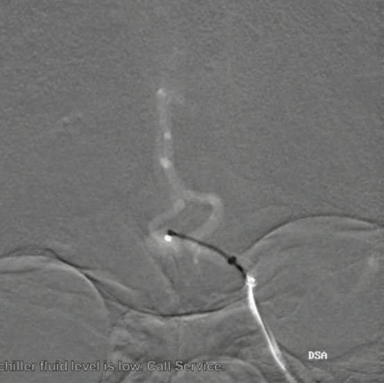 One and Done，一网无余丨湖南首例 刘坤教授：应用WEB瘤内扰流装置治疗前交通复合体动脉瘤一例_血管_导管_手术