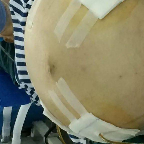 43℃腹腔热灌注化疗：“烫死”癌细胞刚刚好！ 治疗 患者 恶性肿瘤