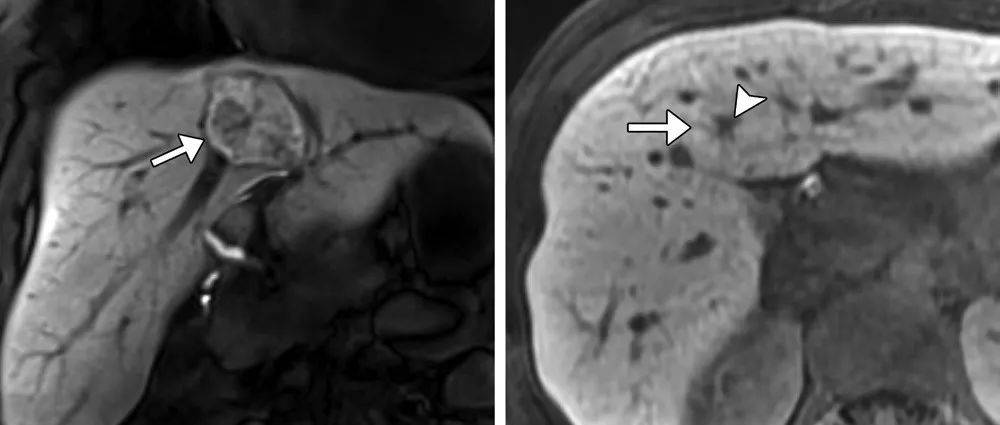 FNH及FNH样病变丨影像表现_信号_肝脏_中央