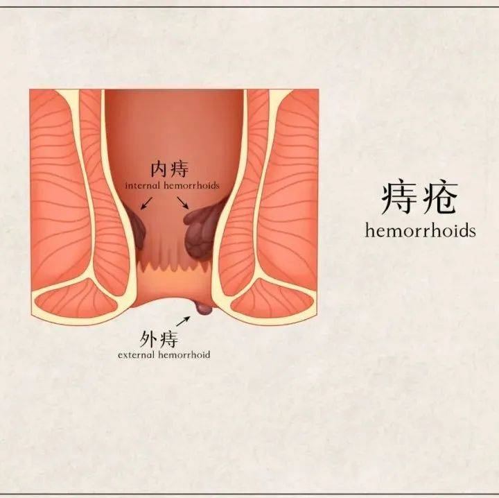 健康 如何识别痔疮和直肠癌次数大便肠道