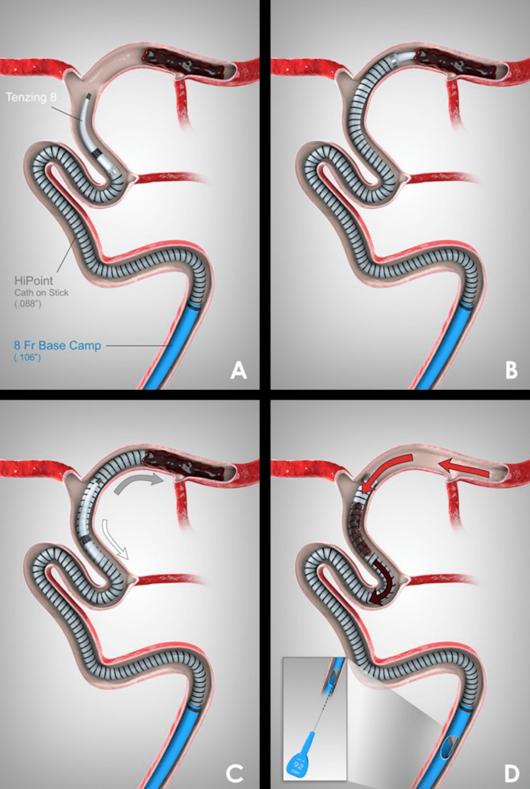 JNIS中文版 | 张猛教授导读：超大口径血栓摄取（SLIC）技术在大血管闭塞患者中可实现高首通效率_导管_HiPoint_导读