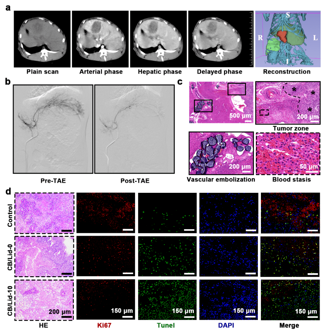 J Transl Med︱韩新巍团队研究发现CalliSpheres载利多卡因微球可用于有效控制栓塞后疼痛并发症的发生_Lid_炎症_模型