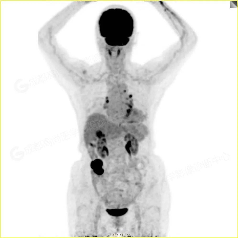 【高尚病例】PET/CT诊断结肠癌1例_肠壁_检查_乙状结肠