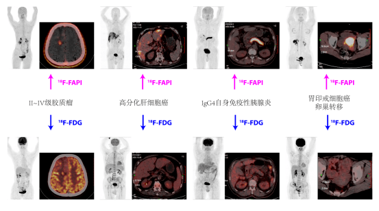 吉大一院核医学科合成和标记新型PET-CT显像剂系列报道（一）——18F-FAPI的PET-CT显像_诊断_临床_肿瘤