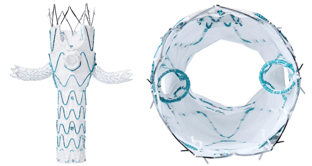 郭伟教授团队发布WeFlow-JAAA腹主动脉支架系统治疗近肾腹主动脉瘤FIM研究结果！_患者_手术