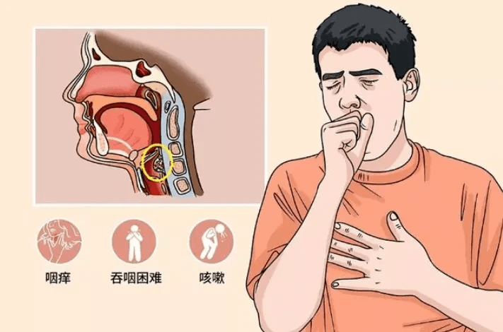 患了咽喉炎会出现什么症状?生活中该怎么缓解不适呢?影响喉咙炎症